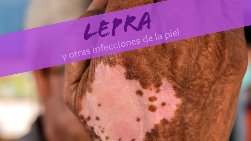 La Lepra y la Psoriasis – La Milpa Central Naturista